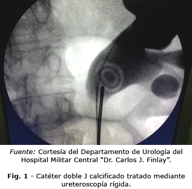 Vista de Tratamiento mínimamente invasivo del catéter doble J ...