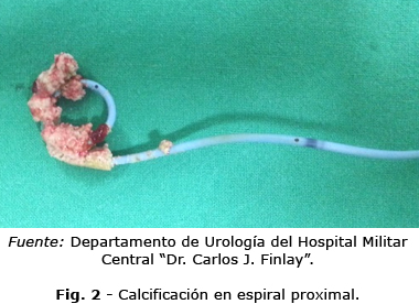 Tratamiento mínimamente invasivo del catéter doble J calcificado