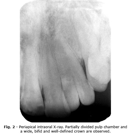 Presentation of infrequent clinical case of dental gemination of the ...