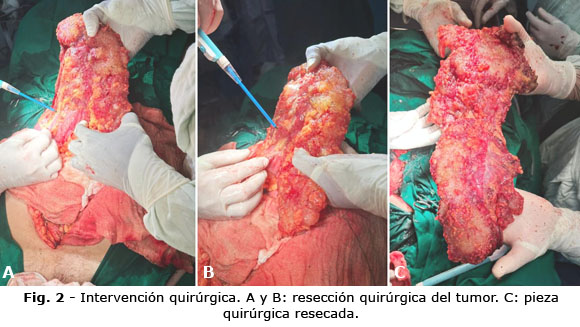 Carcinomatosis Peritoneal Secundaria A Mucocele Apendicular