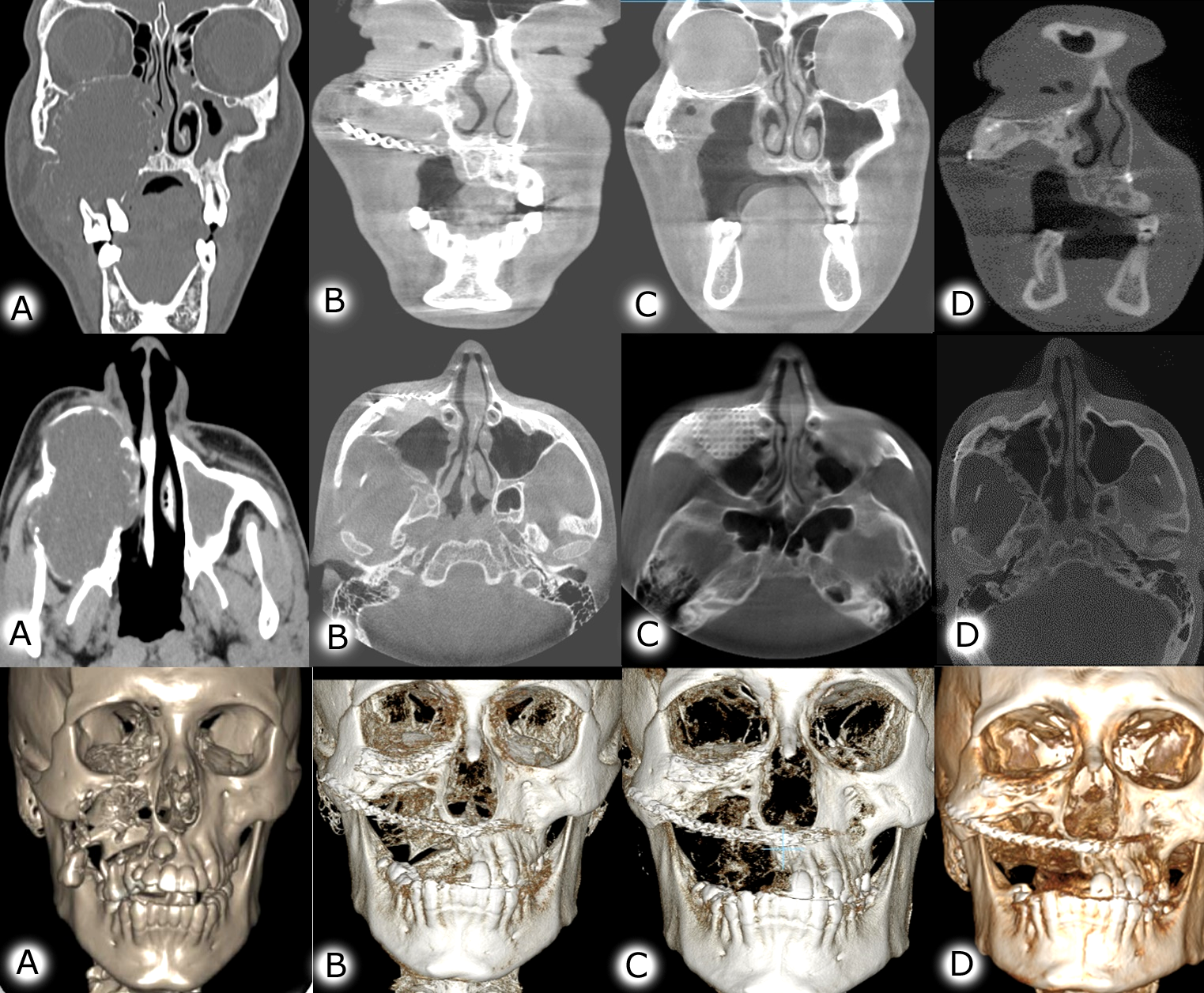 Tratamiento conservador del mixoma odontogénico con extensa afectación ...