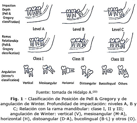 Clasificaciones Pell-Gregory, Winter y Nolla de terceros molares en ...