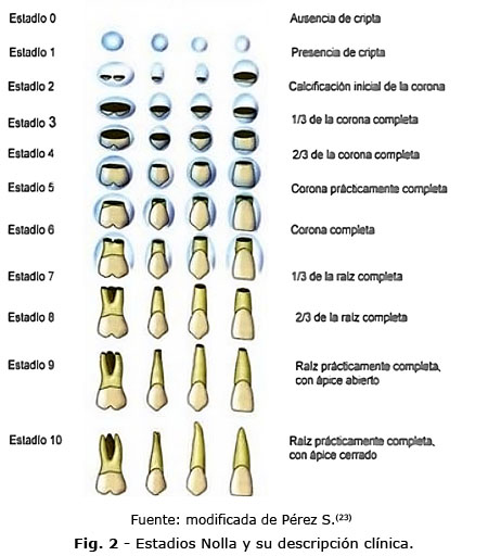 Clasificaciones Pell-Gregory, Winter y Nolla de terceros molares en ...