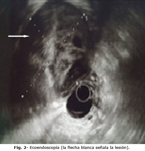Textiloma intrabdominal incidental | Tusen Toledo | Revista Cubana de ...